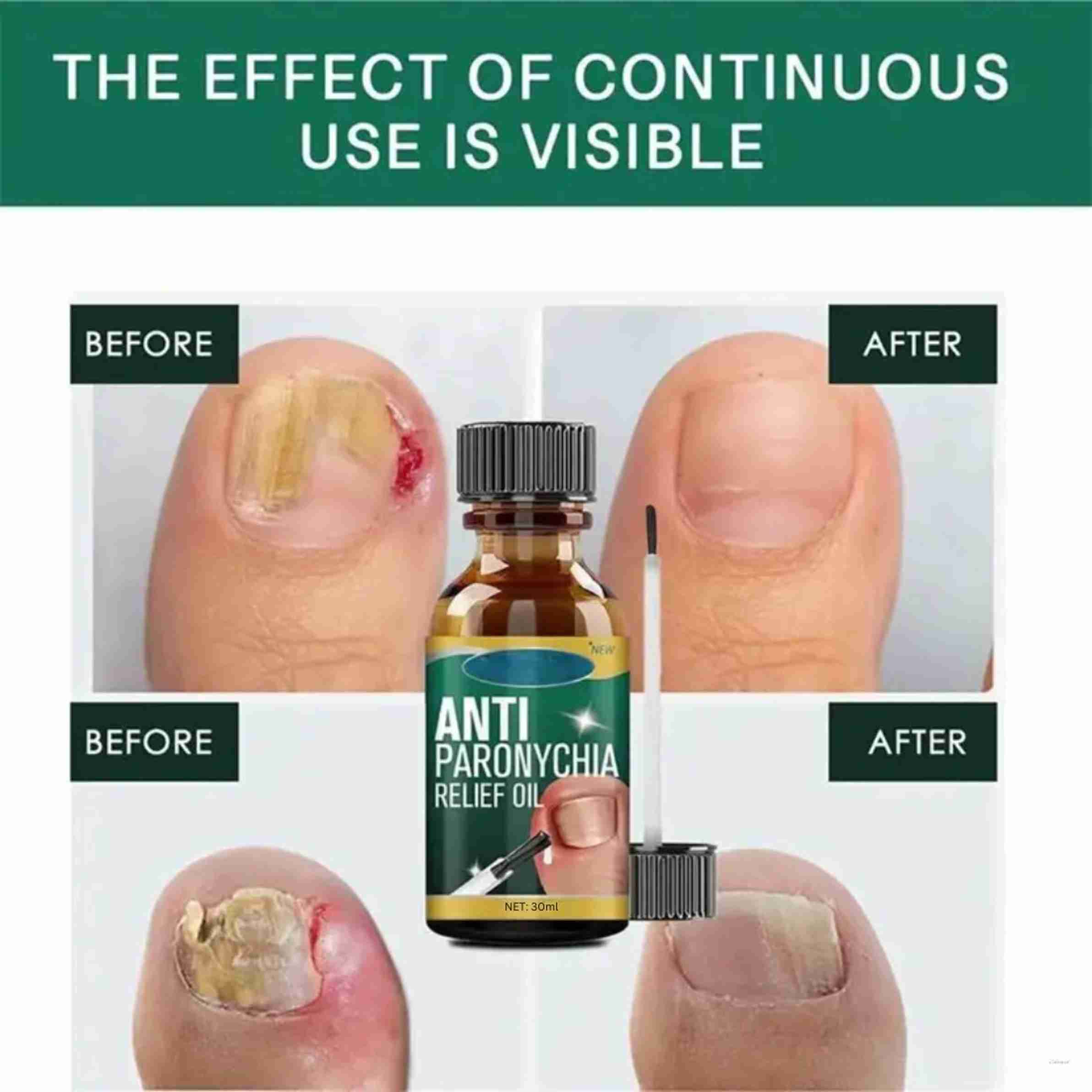 Colorstock Anti Paronychia Relief Oil | Nail Support Revive Care ...