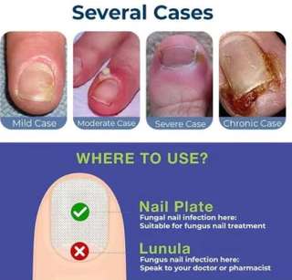 uxoroal Rapid Nail Pain Relief Pack of 2 Liquid - Buy Baby Care ...