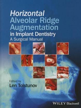 Horizontal Alveolar Ridge Augmentation in Implant Dentistry - A ...