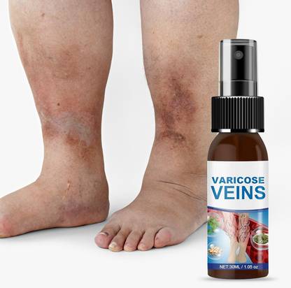 nandurba Herbal Spray for Varicose Veins – Pain & Swelling Relief ...