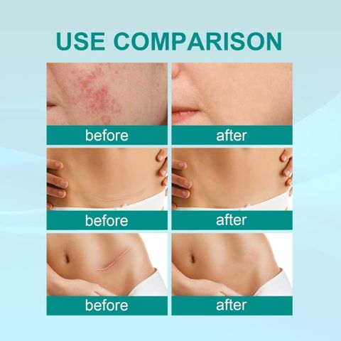 ACTIWOW Medical Grade Spray with Proven Scar Reducing Formula Price in ...