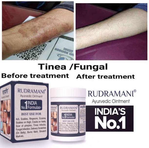 Fungal Infection Cream - Buy Fungal Infection Cream online at Best ...