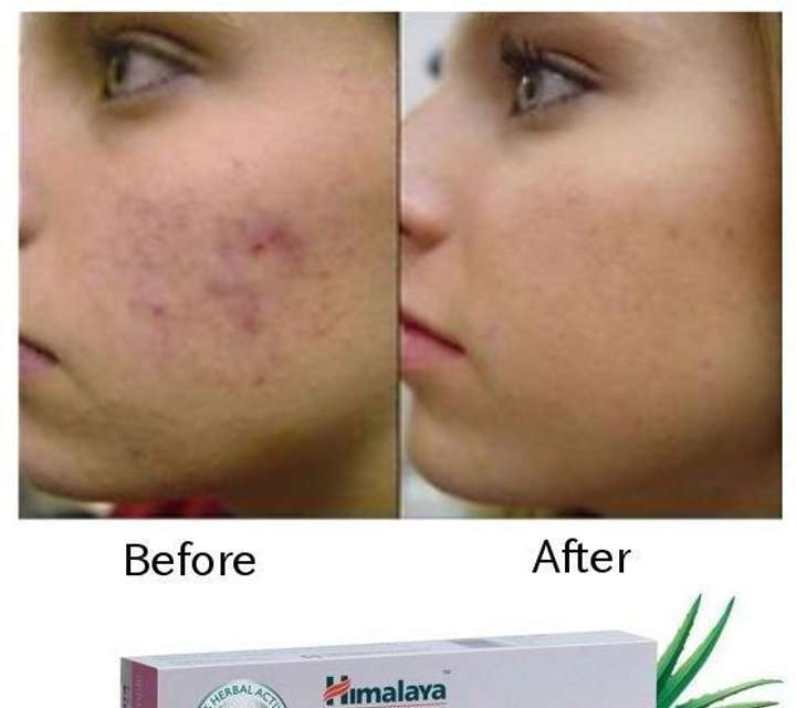 Himalaya Herbals Pimple Clear Cream Pack of 5 100G Price in India Buy Himalaya Herbals Pimple Clear Cream Pack of 5 100G online at Flipkart