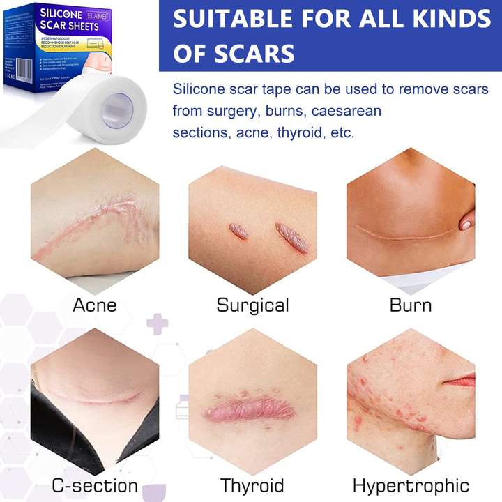 Where to get silicone sheets for scars store