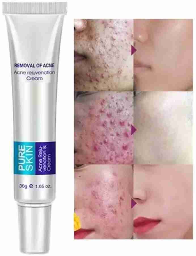 Best acne scar removal product store