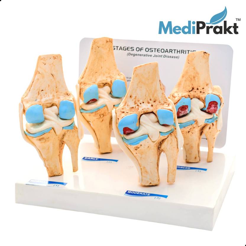MediPrakt | KNEE JOINT ARTHRITIS MODEL | 4 Stage Osteoarthritis | For ...
