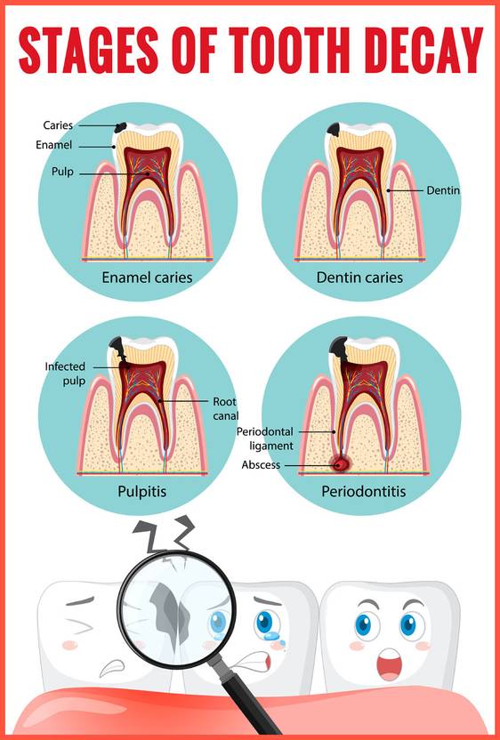 ShubhFly 48 cm Stages Of Tooth Decay Chart for Dental Clinic Poster ...