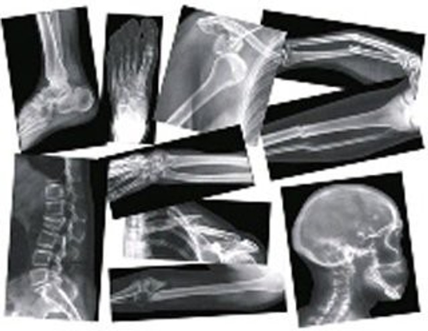 Compound Fractures X Ray