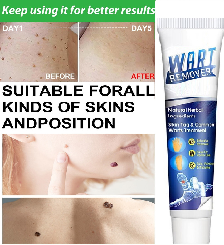 Skin Moles Removal Cream Massa,Mole Removal Cream For Moles On
