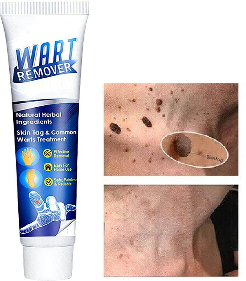 Mole Removal Cream