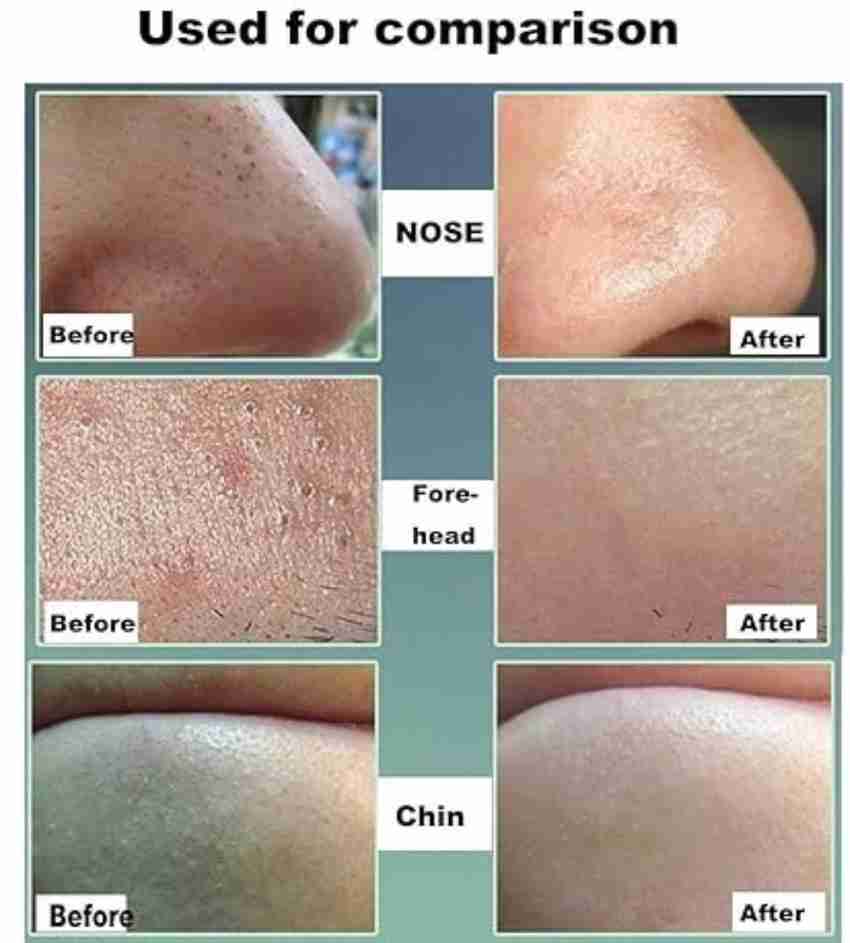 Blackhead Chin