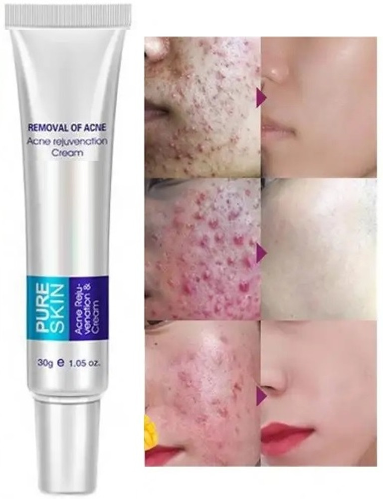 Creams for acne marks store