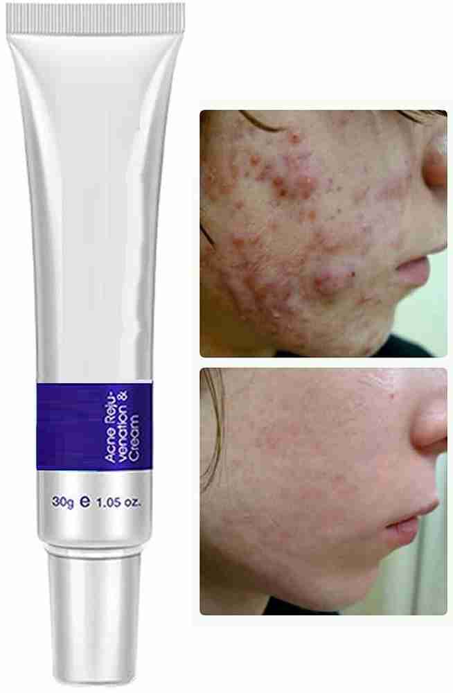 Night cream for acne scars store
