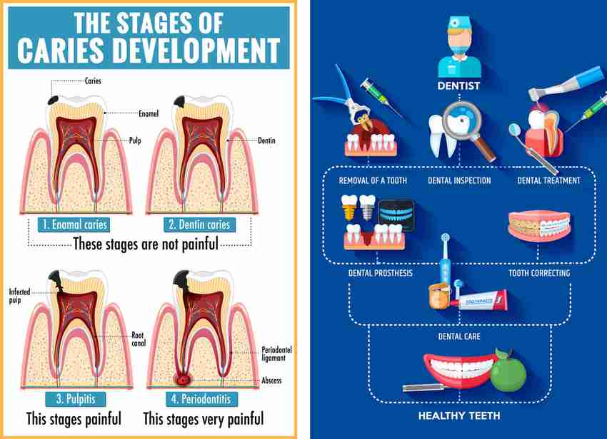 Stages Of Dental Caries 5 Stages Of Tooth Decay