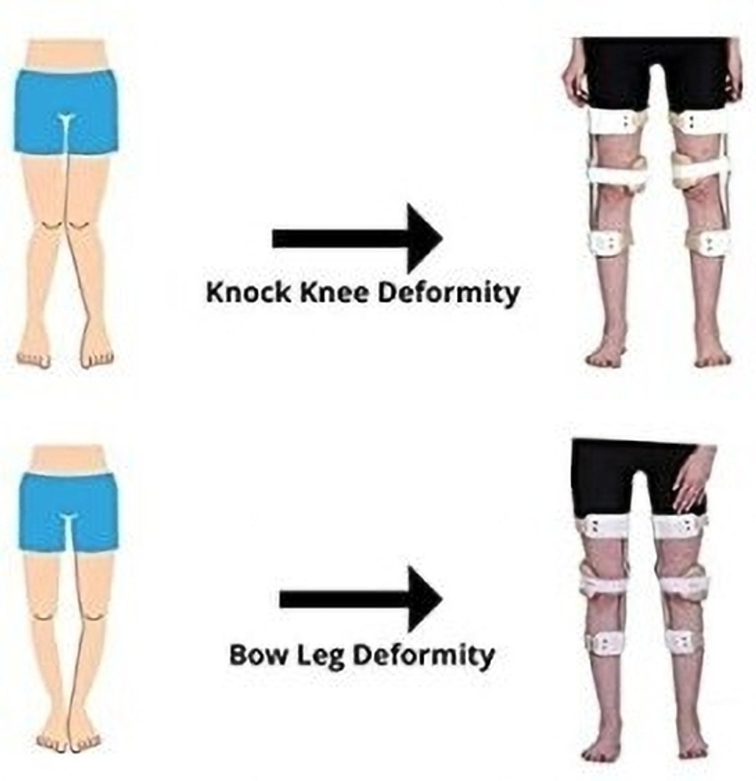 Knock Knee Correction Brace Knock Knees (Genu Valgum) (for Parents)