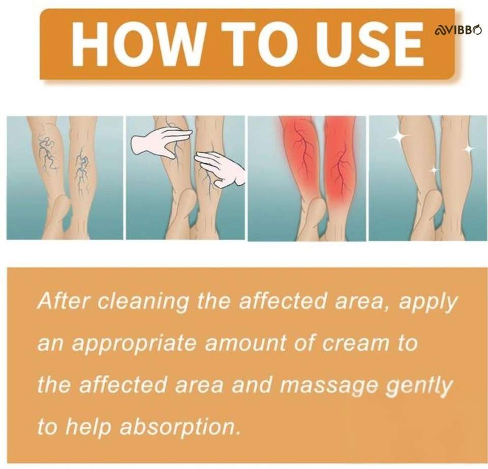 Avibbo Varicose Veins Cream Herbal Leg Care Vein Treatment Cream Cream ...