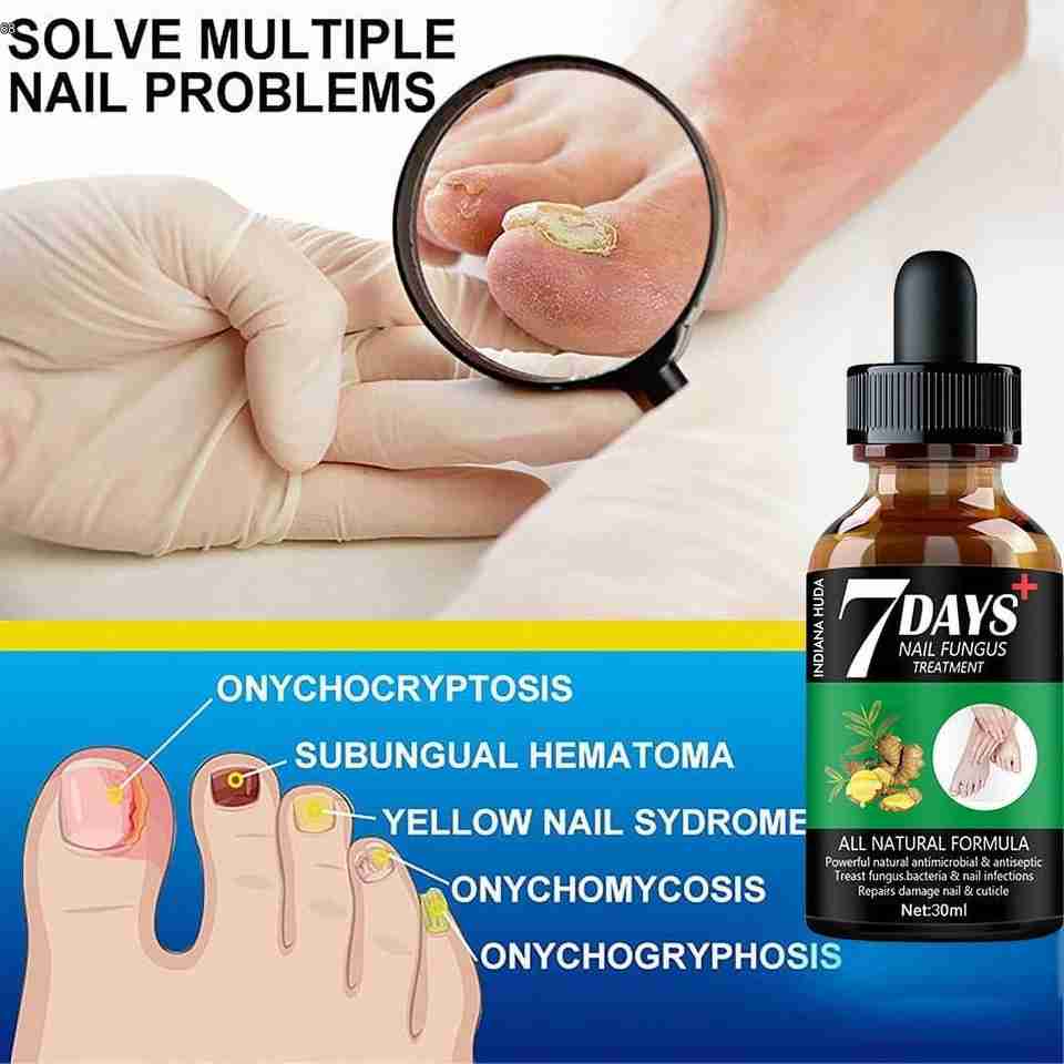 INDIANA HUDA 7 Days Nail Fungus Treatment | Soothing Formula for Nails ...