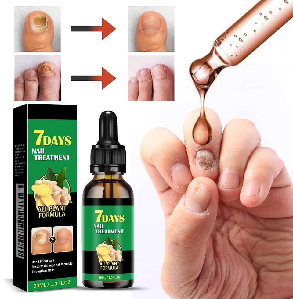 INDIANA HUDA 7 Days Nail Fungus Treatment | Soothing Formula for Nails ...