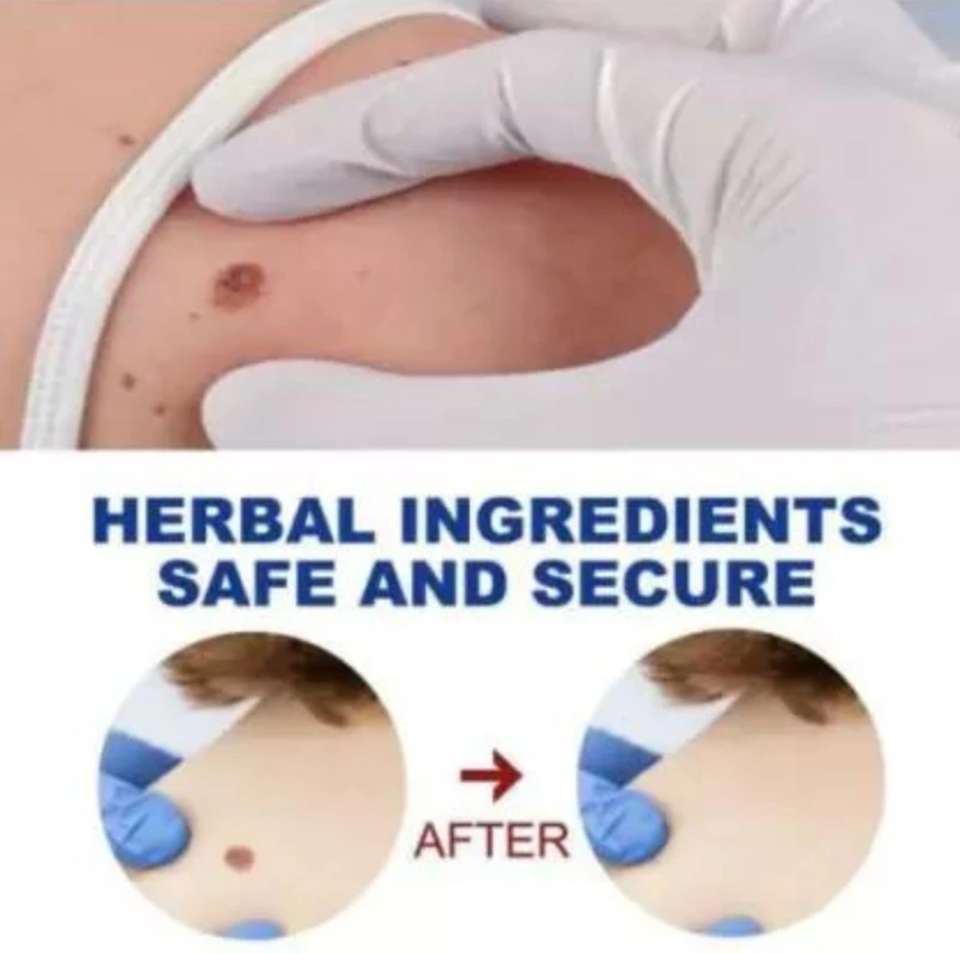 Vana Glow Wart Remover Cream for Gentle Skin Treatment 100g Price in ...
